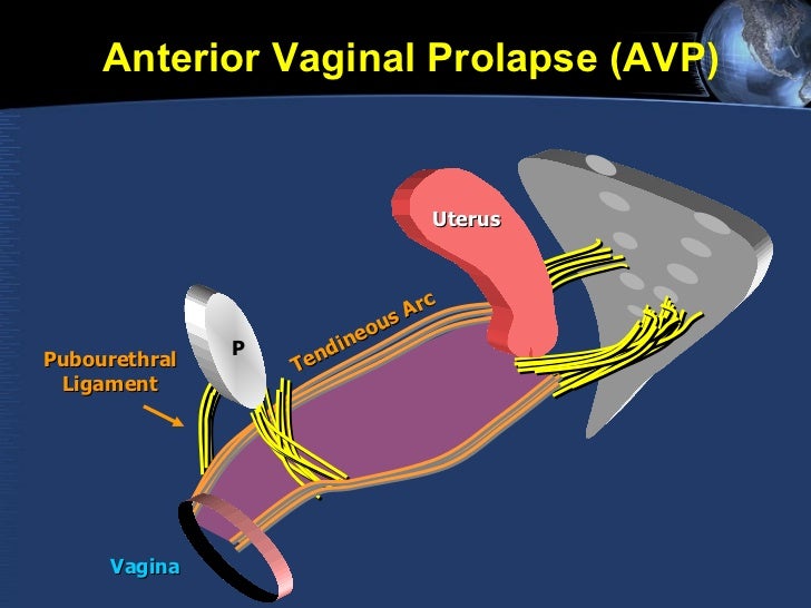 Aplicações práticas dos conceitos anátomo-funcionais : Prolapso Vagi…