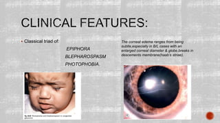 Congenital glaucoma | PPTX