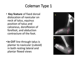 Congenital vertical talus Pes Plano Valgus | PPTX