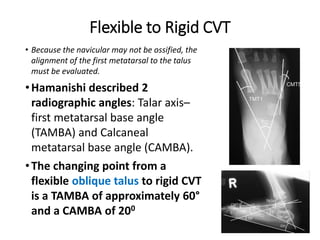 Congenital vertical talus Pes Plano Valgus | PPTX