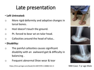 Congenital vertical talus Pes Plano Valgus | PPTX