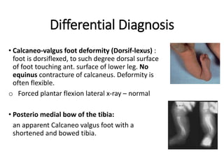 Congenital vertical talus Pes Plano Valgus | PPTX