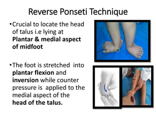 Congenital vertical talus Pes Plano Valgus | PPTX