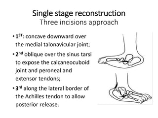 Congenital vertical talus Pes Plano Valgus | PPTX
