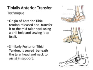 Congenital vertical talus Pes Plano Valgus | PPTX