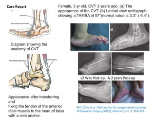 Congenital vertical talus Pes Plano Valgus | PPTX
