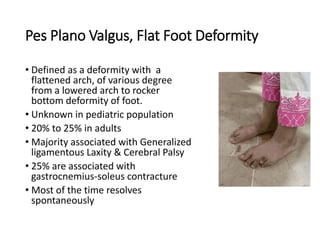 Congenital vertical talus Pes Plano Valgus | PPTX