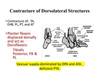 Congenital vertical talus Pes Plano Valgus | PPTX
