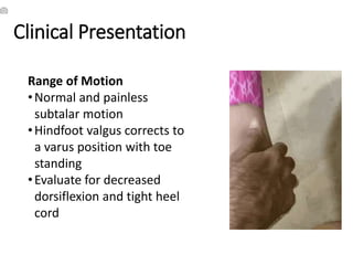 Congenital vertical talus Pes Plano Valgus | PPTX