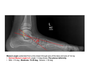 Congenital vertical talus Pes Plano Valgus | PPTX