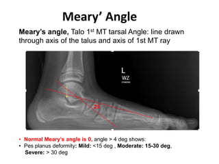 Congenital vertical talus Pes Plano Valgus | PPT