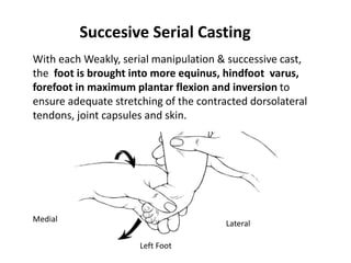 Congenital vertical talus Pes Plano Valgus | PPT