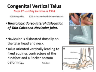 Congenital vertical talus Pes Plano Valgus | PPT