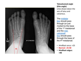 Congenital vertical talus Pes Plano Valgus | PPT