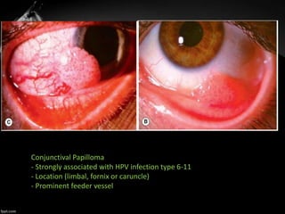 Conj lymphma clinic app. | PPT