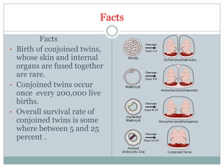 conjoined twins J.pptx