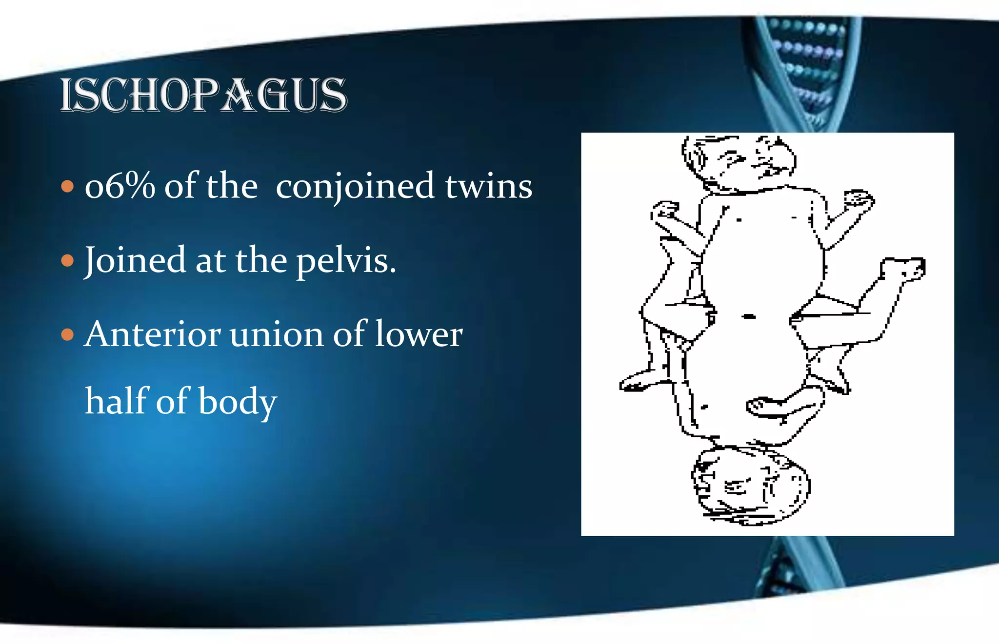 Conjoined twins | PPTX
