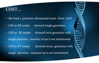 Conjoined twins | PPTX