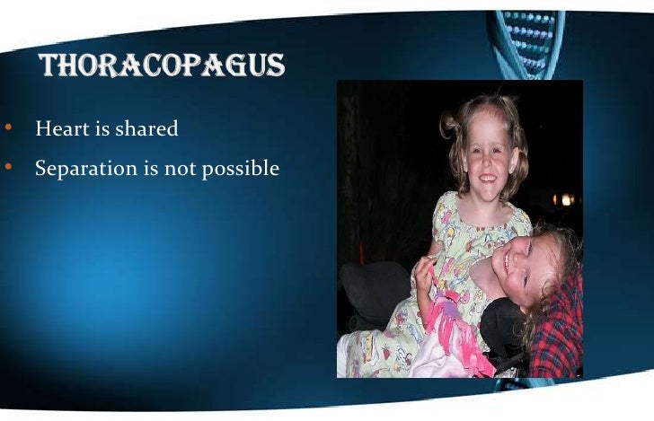 Conjoined twins