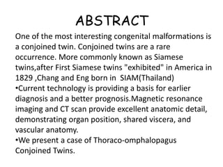 Conjoined twins | PPTX