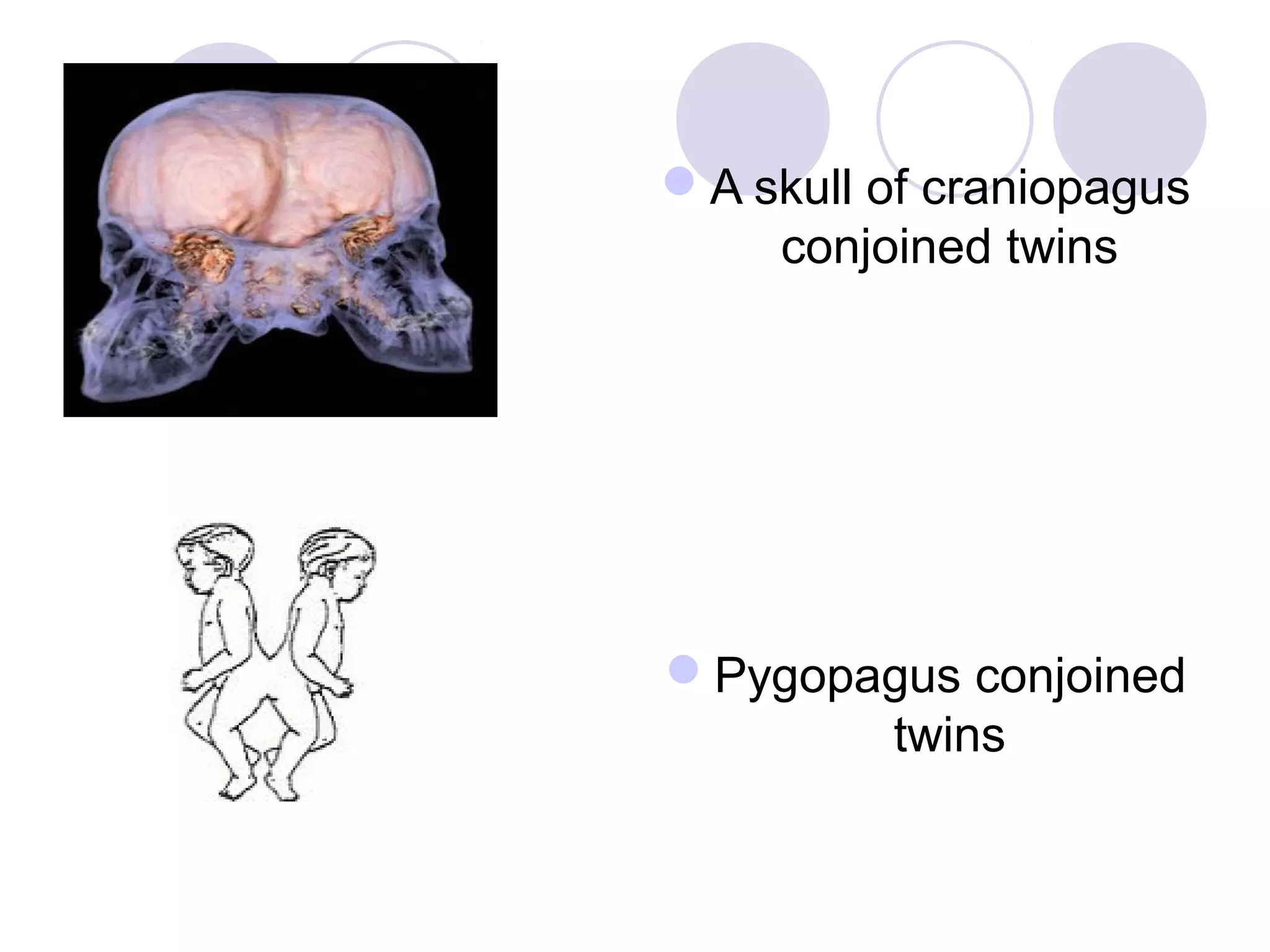 Conjoined twins | PPT