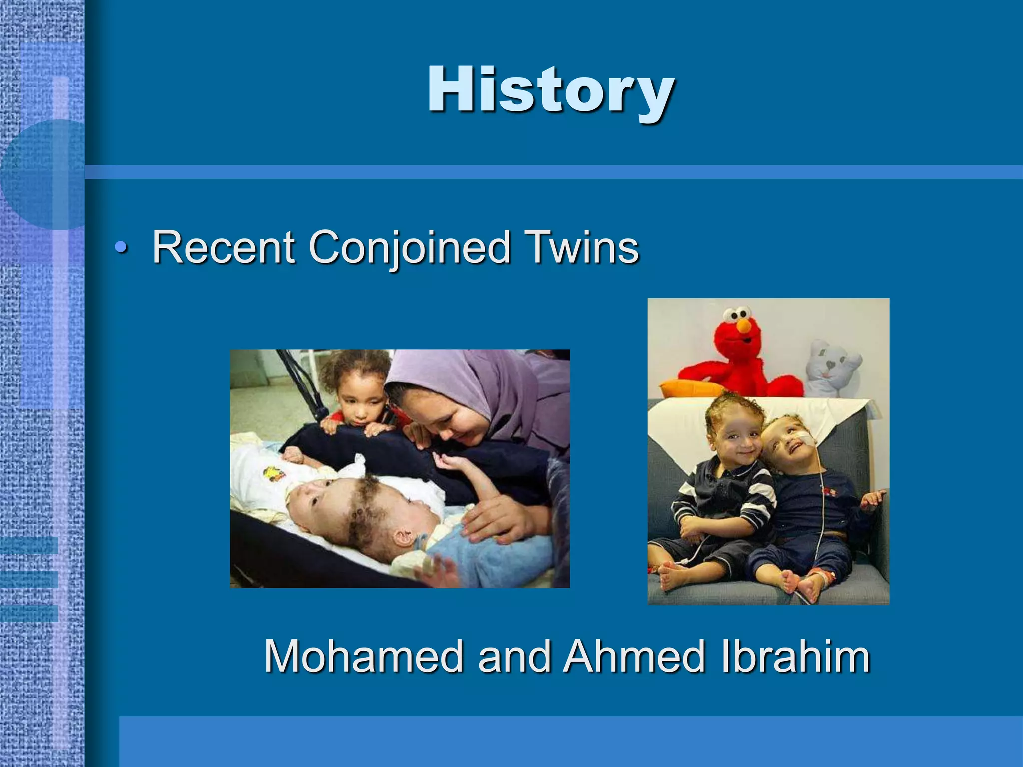 Conjoined twins | PPT