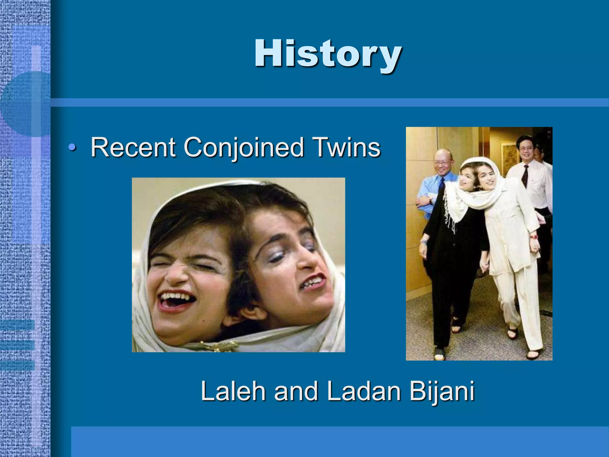 Conjoined twins | PPT