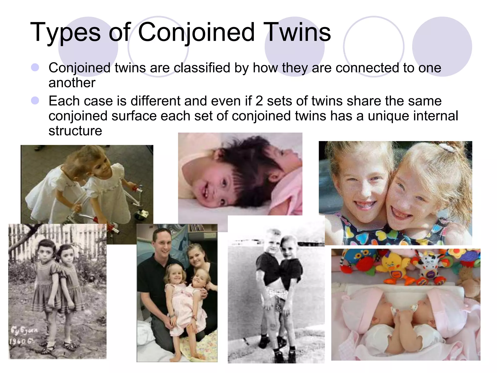 Conjoined Twins.ppt