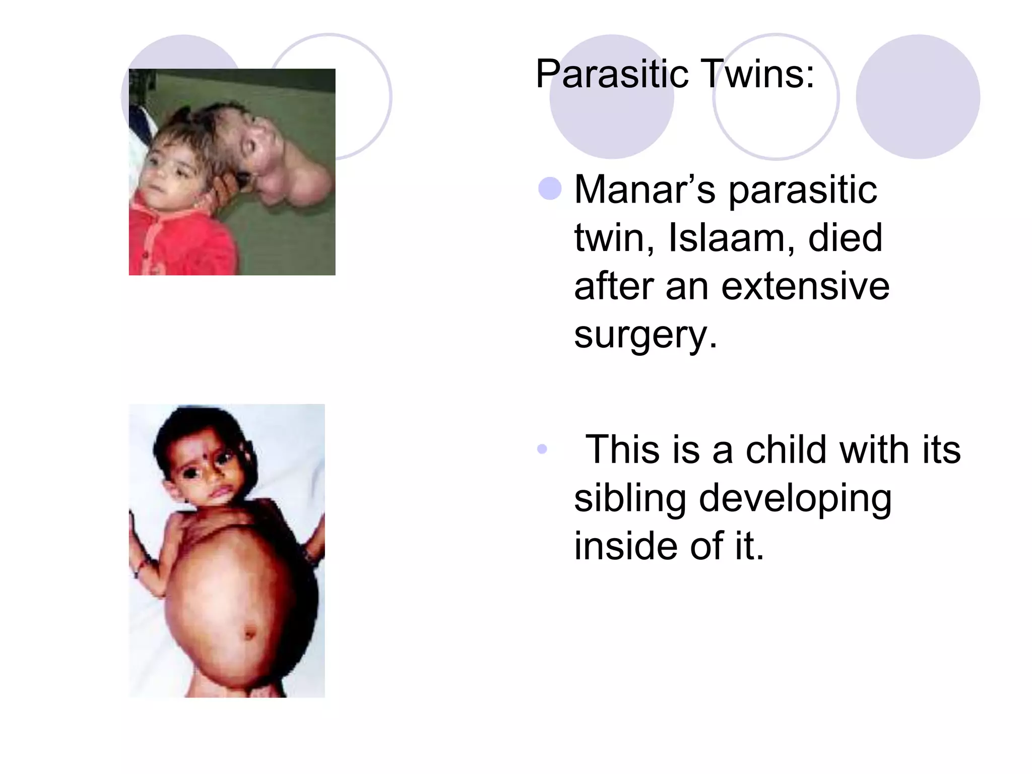 Conjoined Twins.ppt