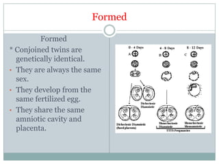 Conjoined Twins J | PPTX