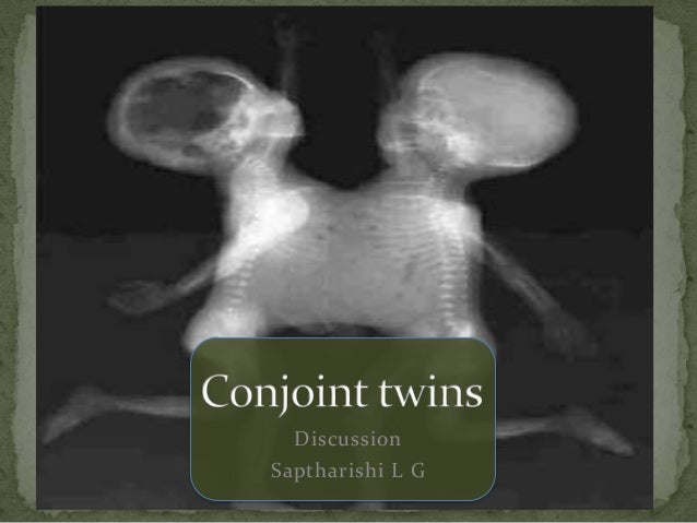 Conjoint twins - case n review