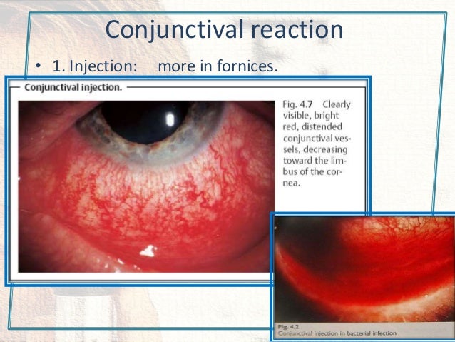 Conjuctival diseases