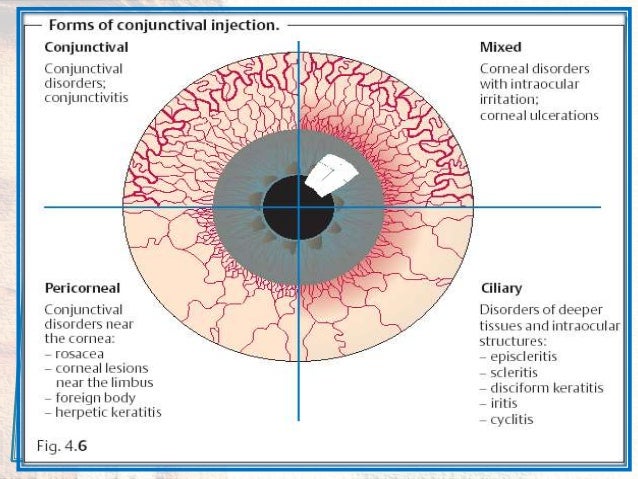 Conjuctival diseases