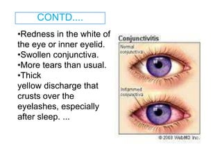 Conjuctival disorders | PPT