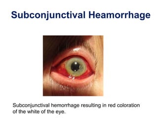 Conjuctival disorders | PPT