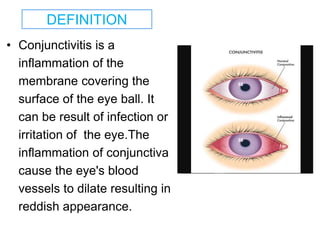 Conjuctival disorders | PPT