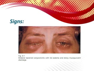 Mucopurulent Conjuctivitis | PPT