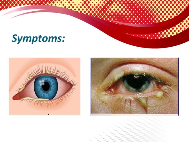 Mucopurulent Conjuctivitis | PPT | Eye and Vision Conditions | Diseases ...