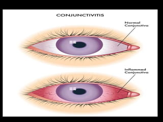 Conjunctivitis | PPTX