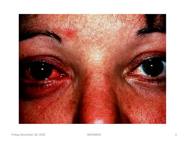 Conjuctivitis | PPTX | Eye and Vision Conditions | Diseases and Conditions