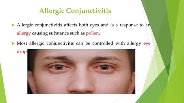Conjuctivitis.pptx