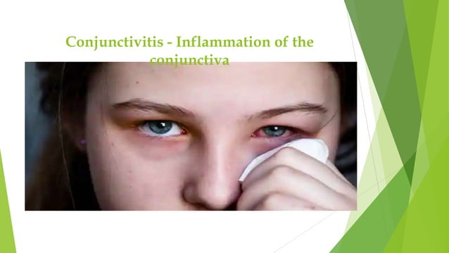 Conjuctivitis.pptx
