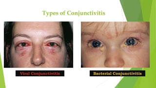 Conjuctivitis.pptx