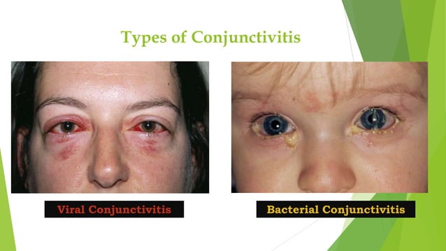 Conjuctivitis.pptx