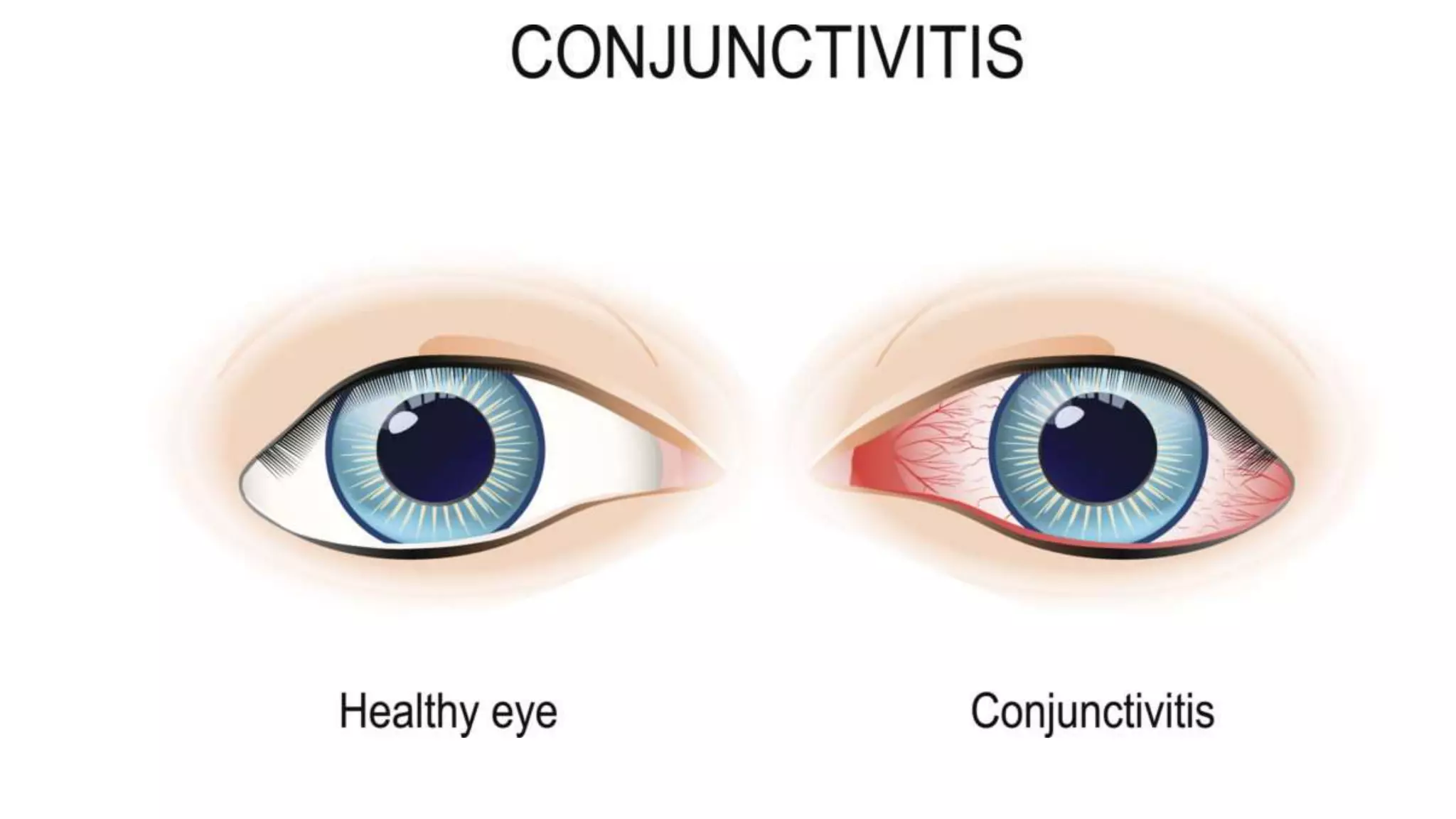 CONJUCTIVITIS-paula.pptx