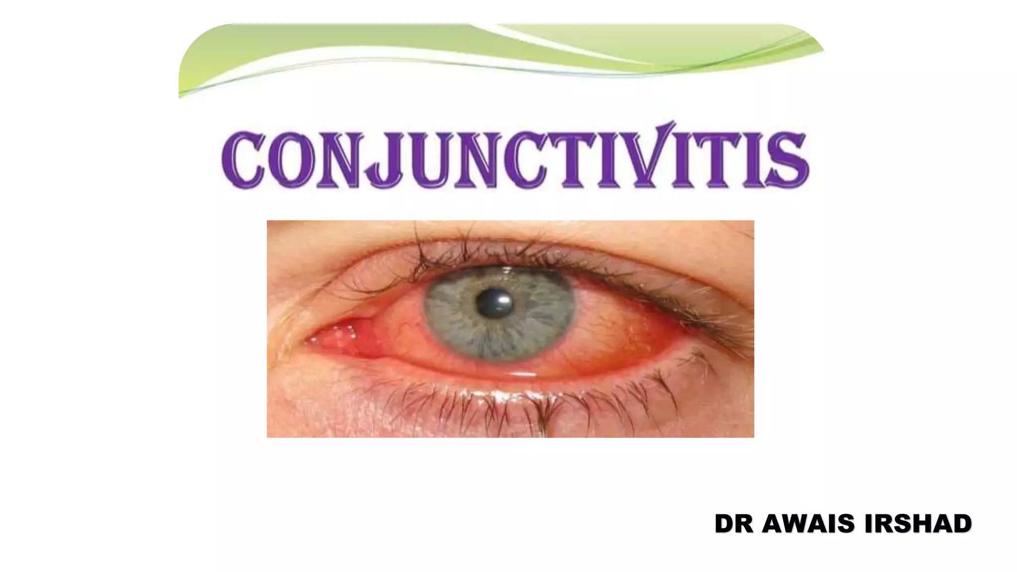 CONJUCTIVITIS FINAL | PPTX