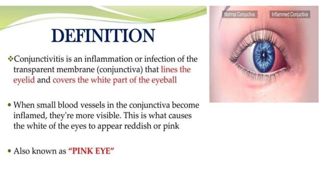 CONJUCTIVITIS FINAL | PPTX | Eye and Vision Conditions | Diseases and ...