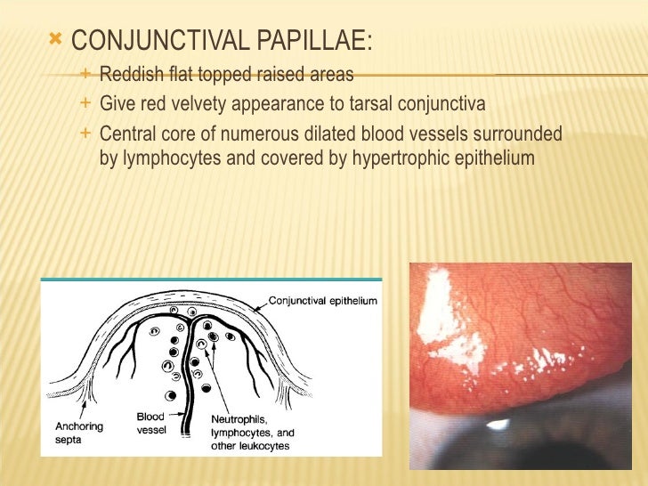 Conjunctiva & Its disorders