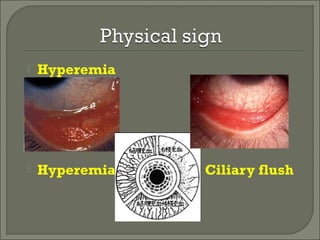 Conjunctival Hyperemia