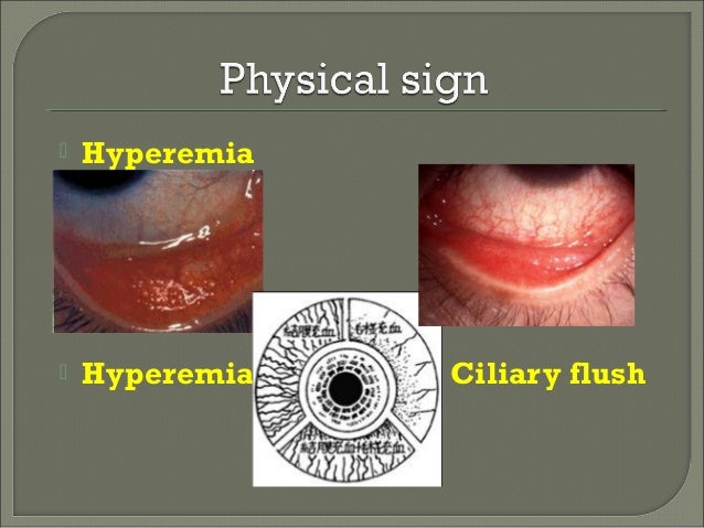 Disease of Conjunctiva.